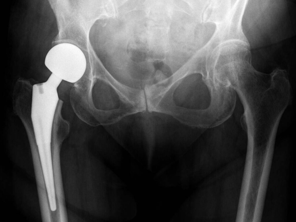 Hip Replacement - Central Maine Healthcare